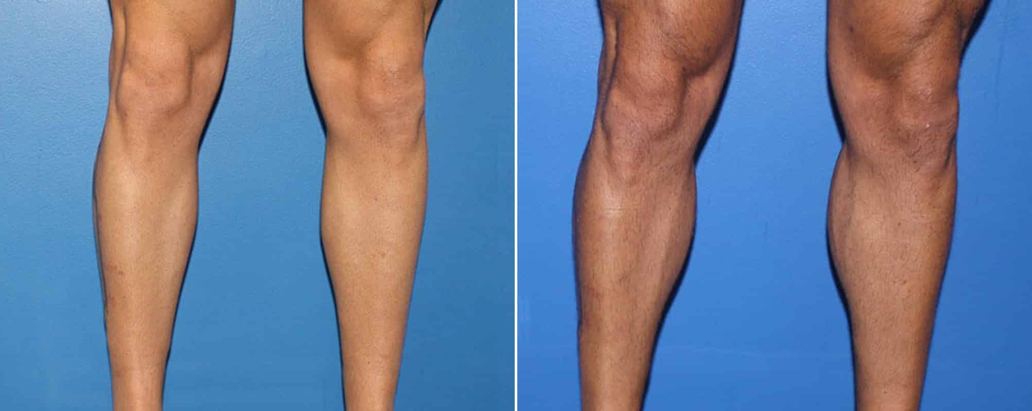 Calf Implants in New York City | Dr. Douglas Steinbrech