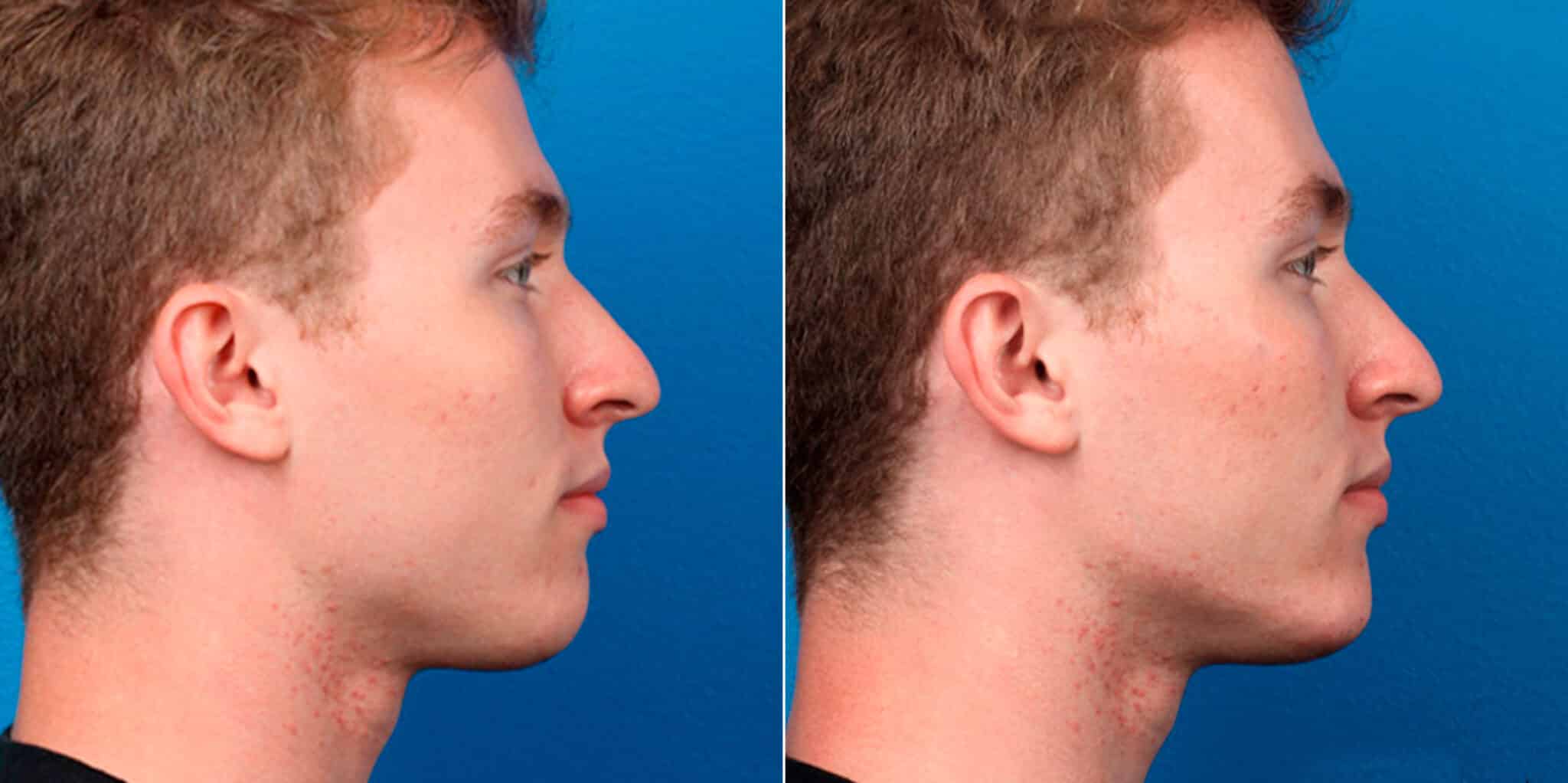 Male Model Make Over Photos New York Ny Patient 16922