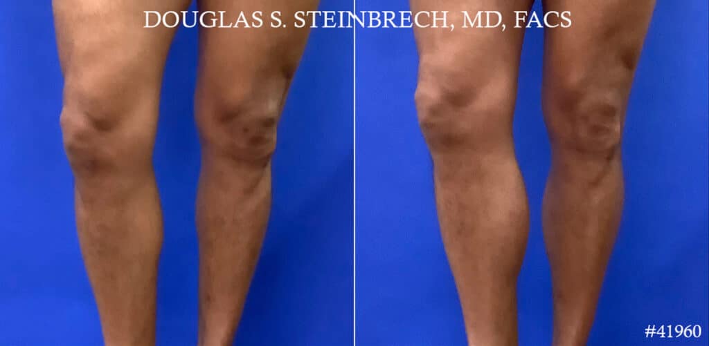 Calf Implants in NYC | Dr. Steinbrech | Plastic Surgery