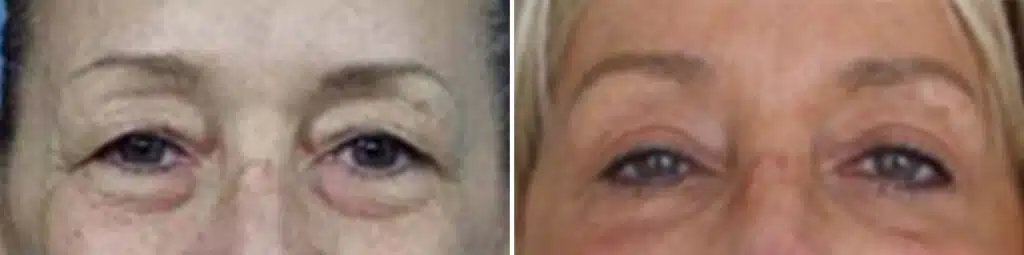 Understanding Blepharoplasty Scars: What to Expect