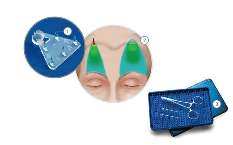 The Endotine Brow Lift Technique: In-Depth Guide