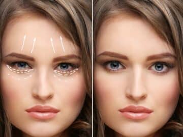 Achieve a Refined Look: Endoscopic Brow Lift Procedure