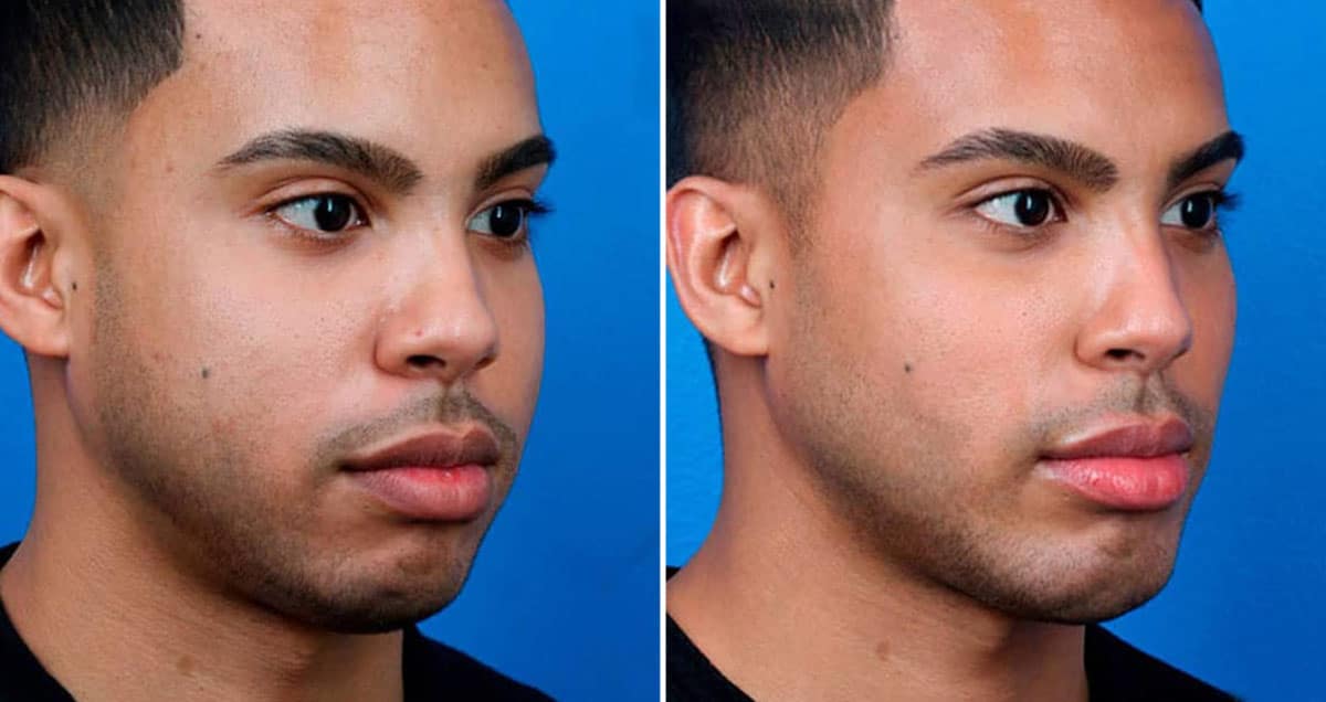 Man Chin Shapes Chin Augmentation New York City | Dr. Douglas